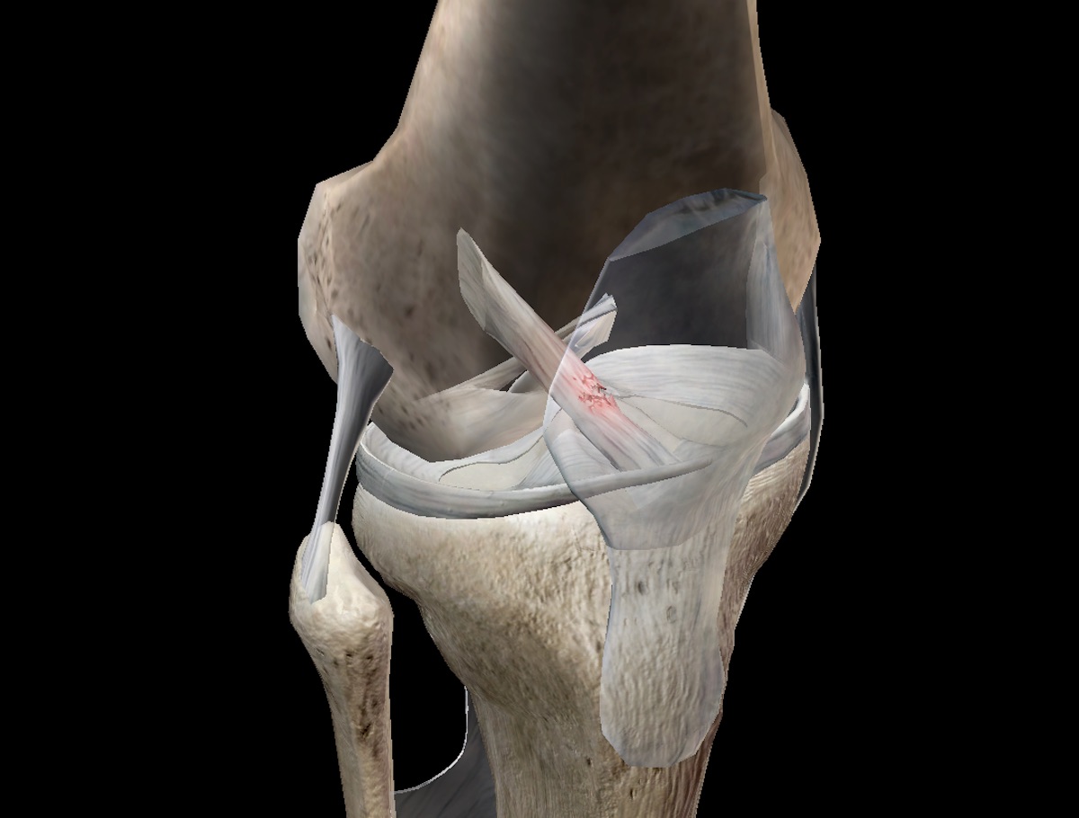 Quando il legamento crociato anteriore si rompe in un giovane atleta ...